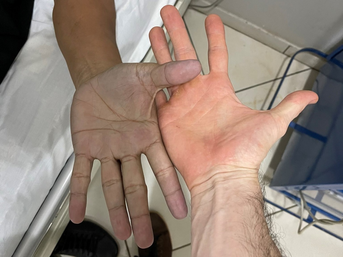 Recibió a un paciente con las manos azules y el diagnostico fue increíble